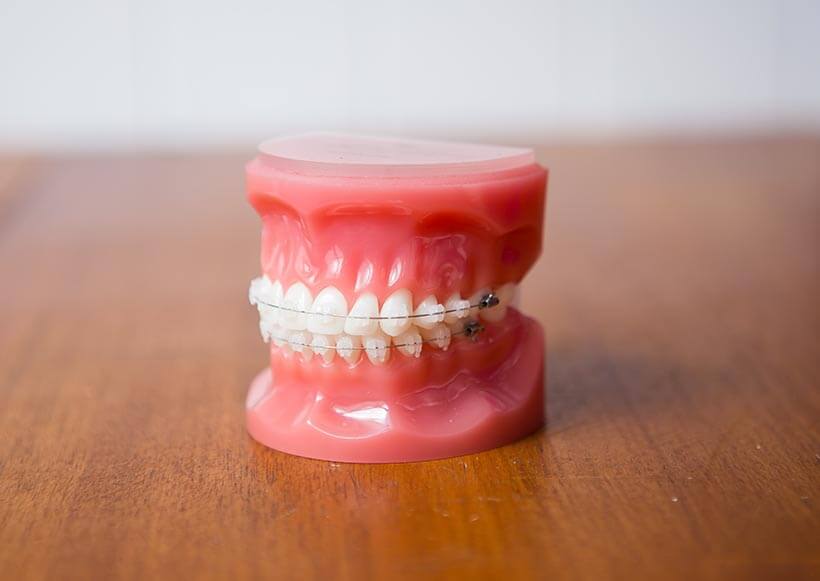 Ceramic (Clear) Braces | Westside Orthodontics